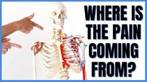 Sciatica In Neck And Shoulder | It's Signs & Treatment